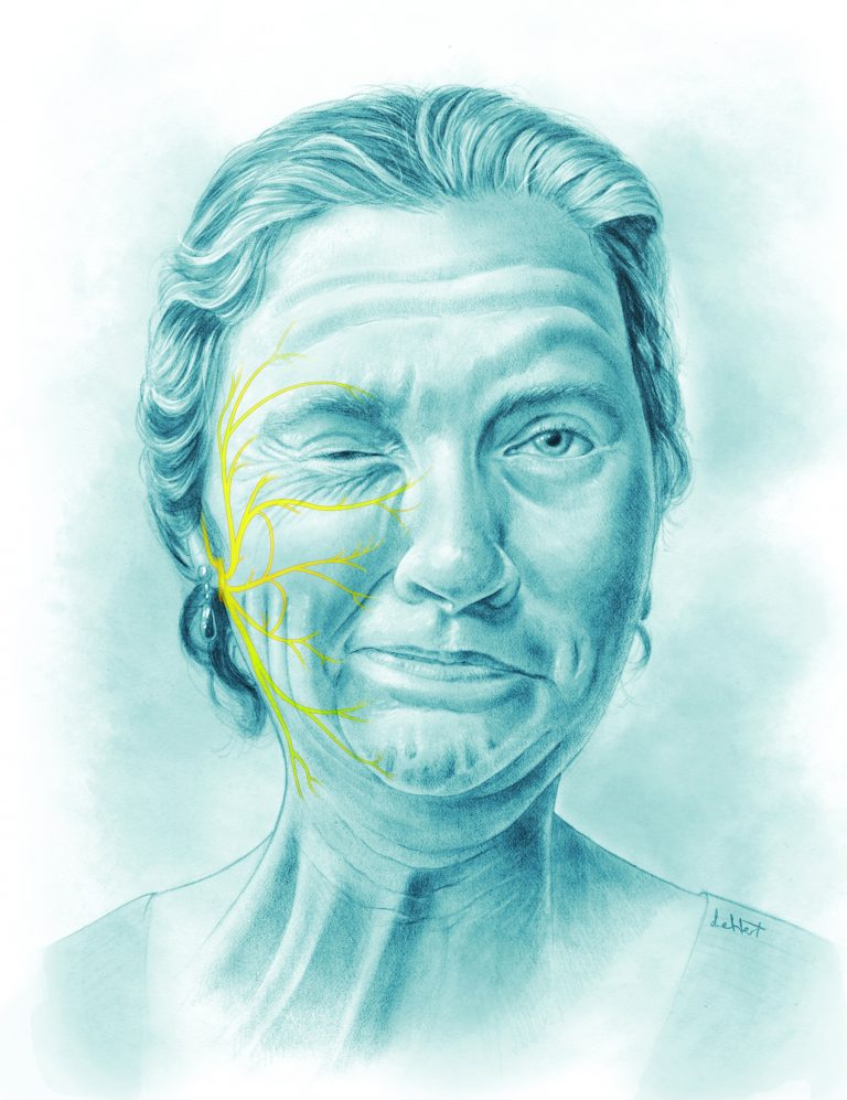 Hemifacial Spasm Causes and Treatments - SeattleNeurosciences.com